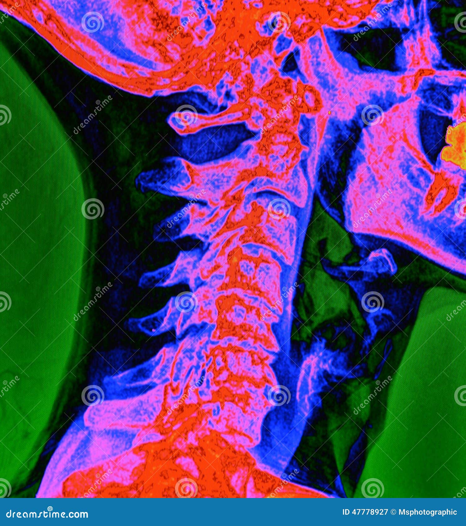 Spine X-Ray in Color stock image. Image of back, science - 47778927