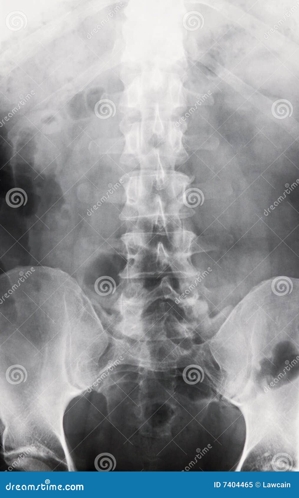 Spine X-ray and Iliac Crests Stock Image - Image of column, medical ...