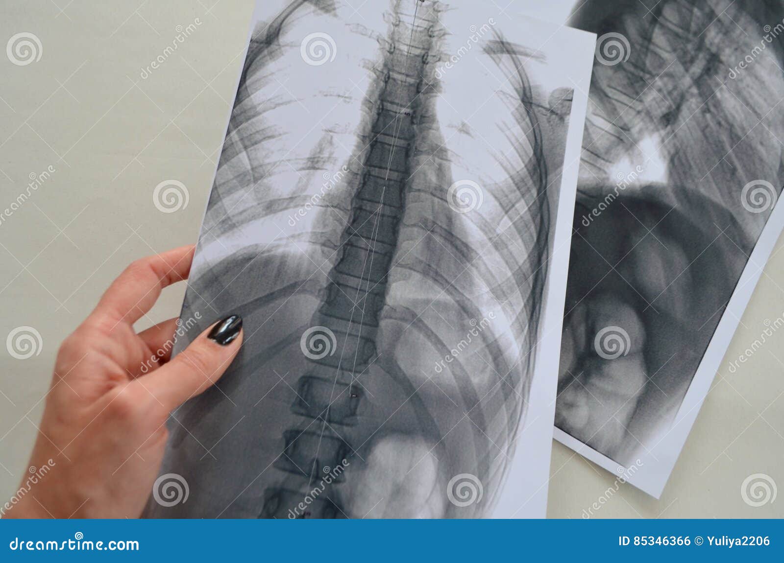 Spine Rengen picture stock photo. Image of body, hemarthrosis - 85346366