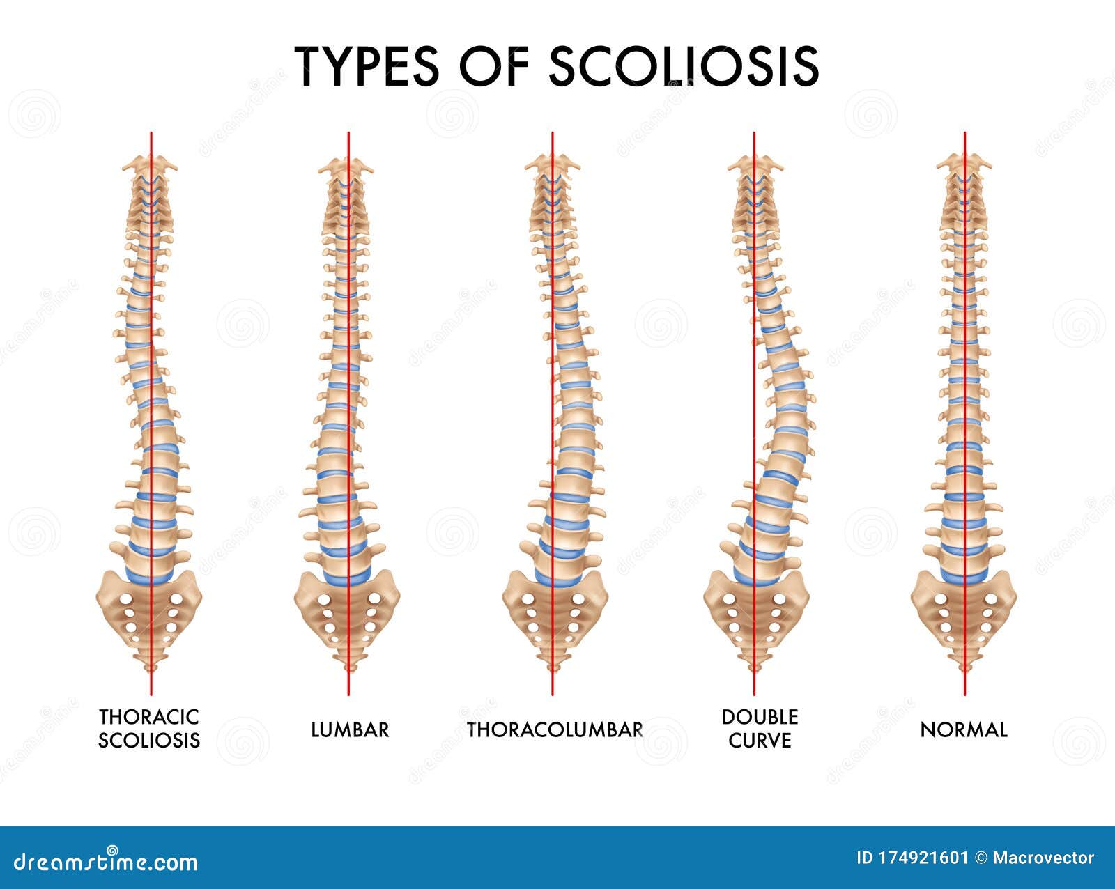 Scoliose Stock Illustrations, Vectors, & Clipart – (2,844 Stock ...