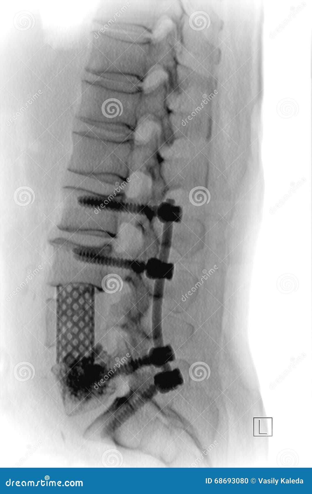 Spine Surgical Reconstruction Stock Photo - Image of repair ...