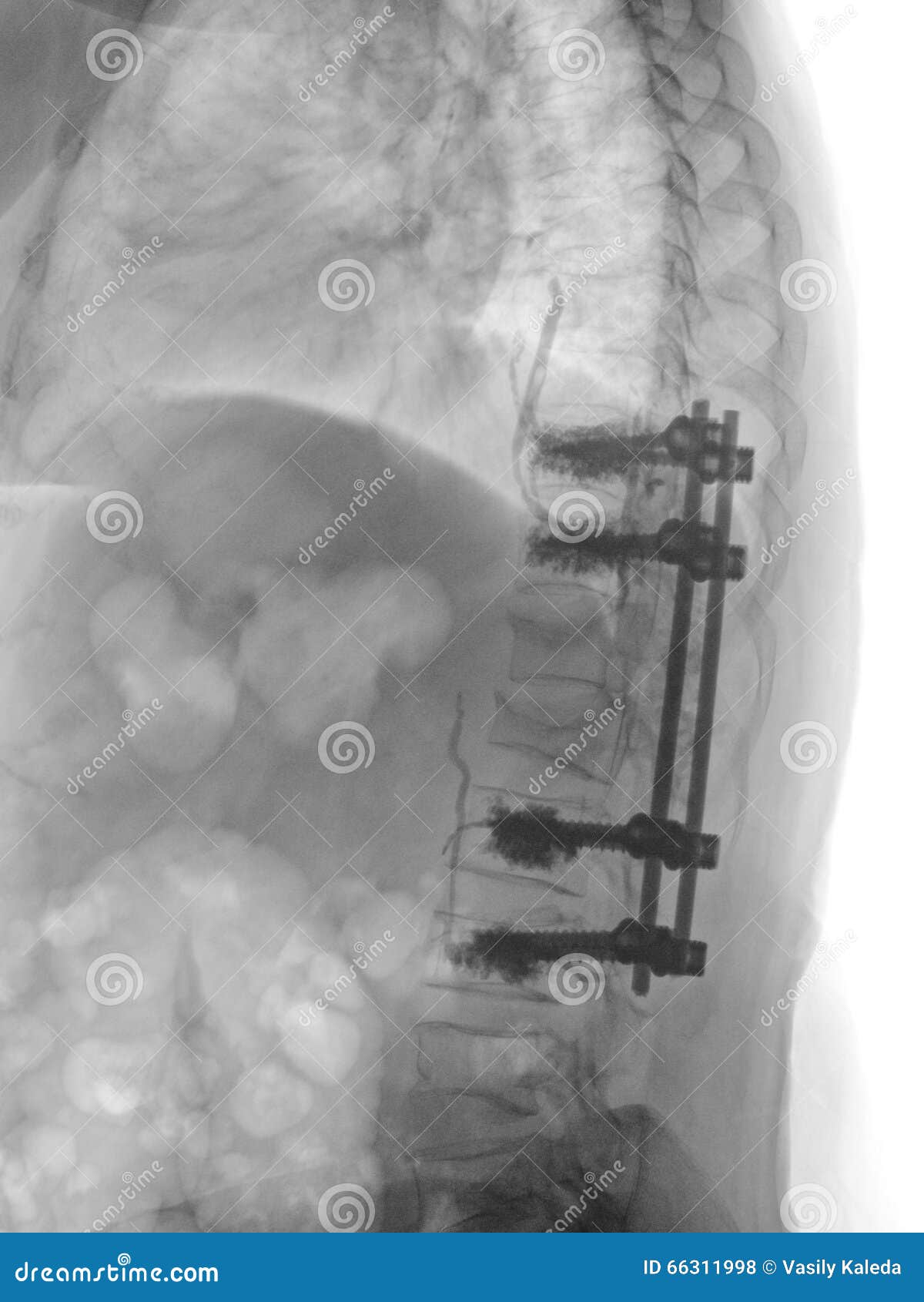 Spine Surgical Reconstruction Stock Photo - Image of diagnostic, spine ...