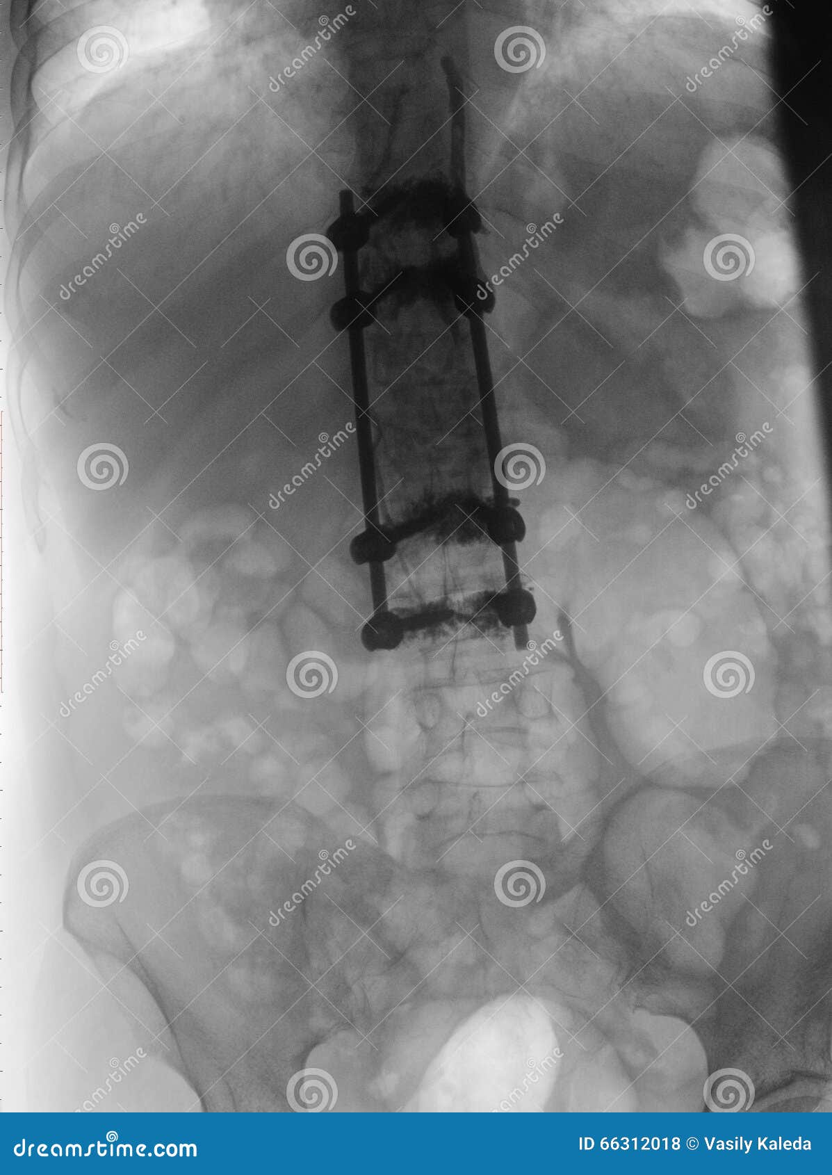 Spine Surgical Reconstruction Stock Photo - Image of roentgenogram ...