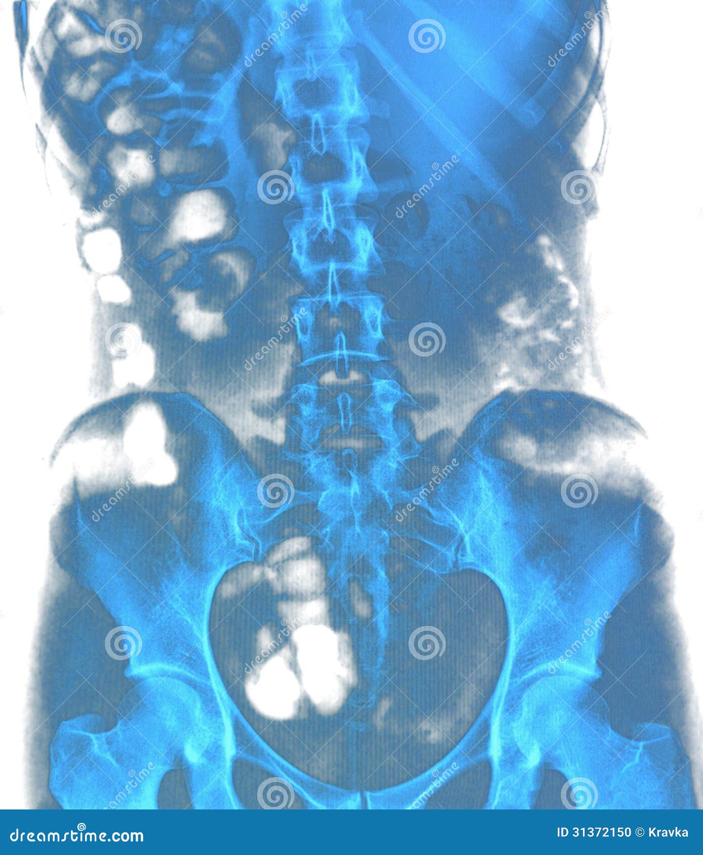 Spine xray stock photo. Image of sick, medical, heal - 31372150