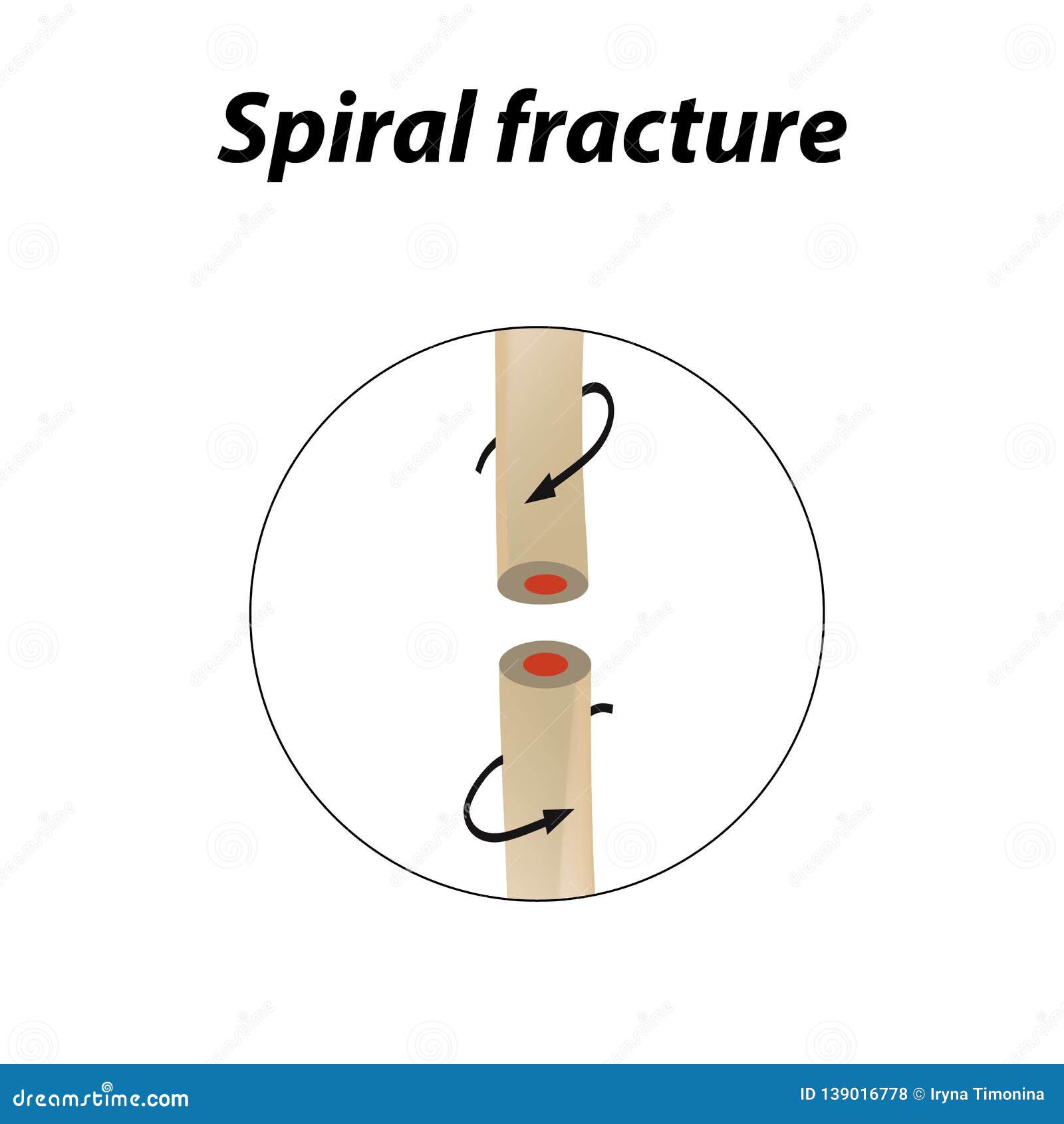 Greenstick Fracture Bone. Infographics. Vector Illustration On A Lined ...