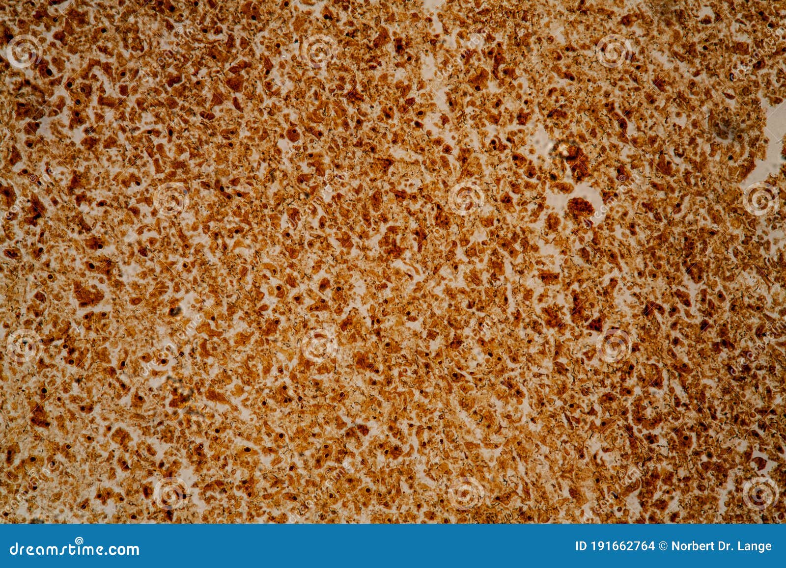 Liver Tissue With Amyloidosis Under A Microscope Royalty-Free Stock ...