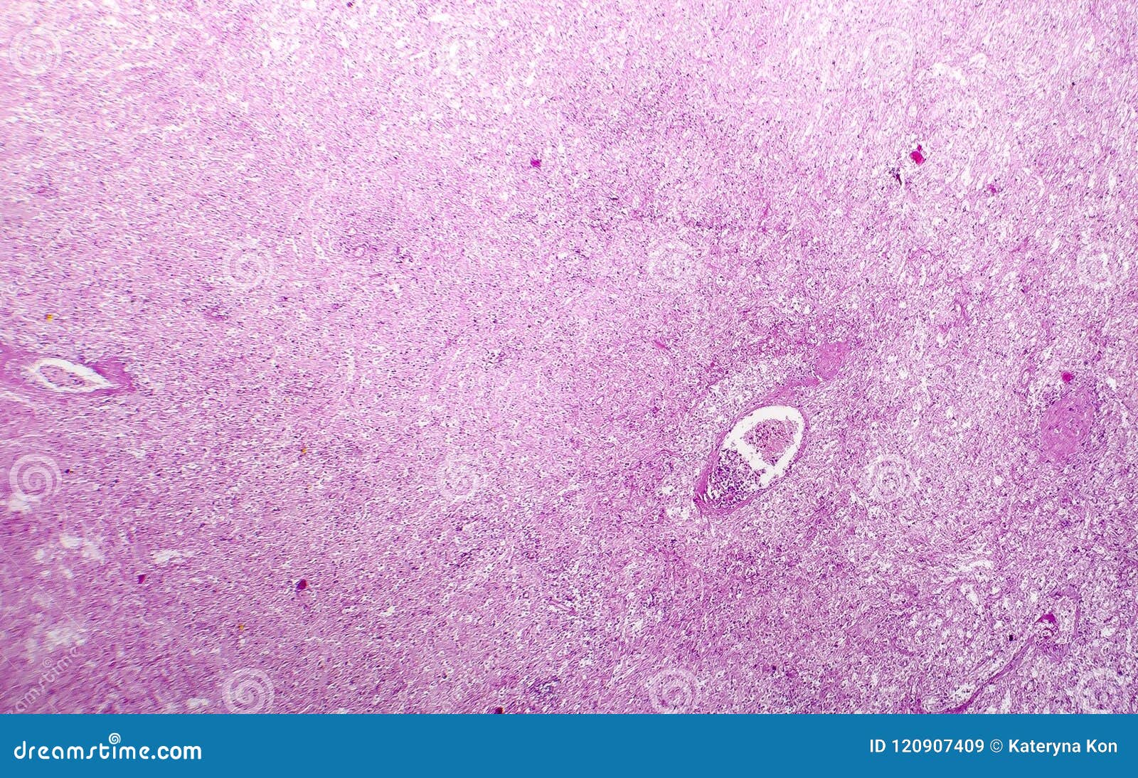 Splenic Infarction, Photo Under Microscope Stock Image - Image of ...