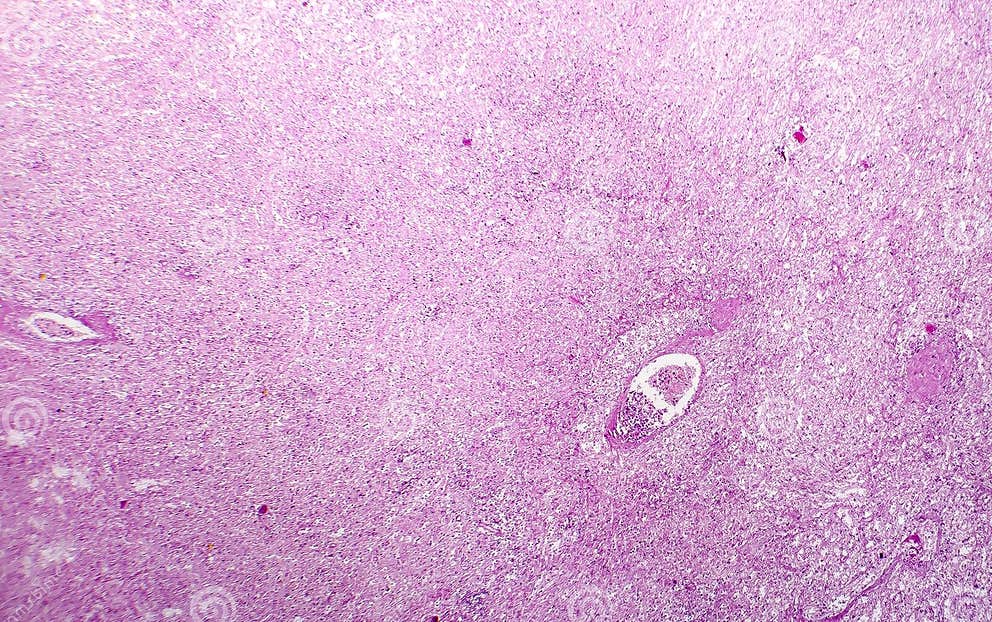 Splenic Infarction, Photo Under Microscope Stock Image - Image of ...