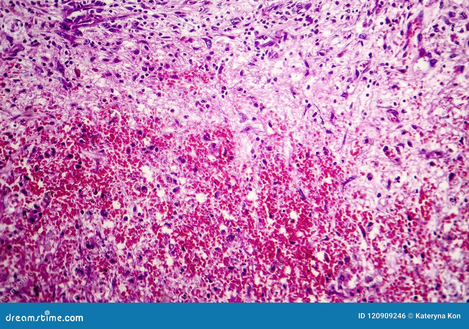 Splenic Infarction, Photo Under Microscope Stock Photo - Image of ...