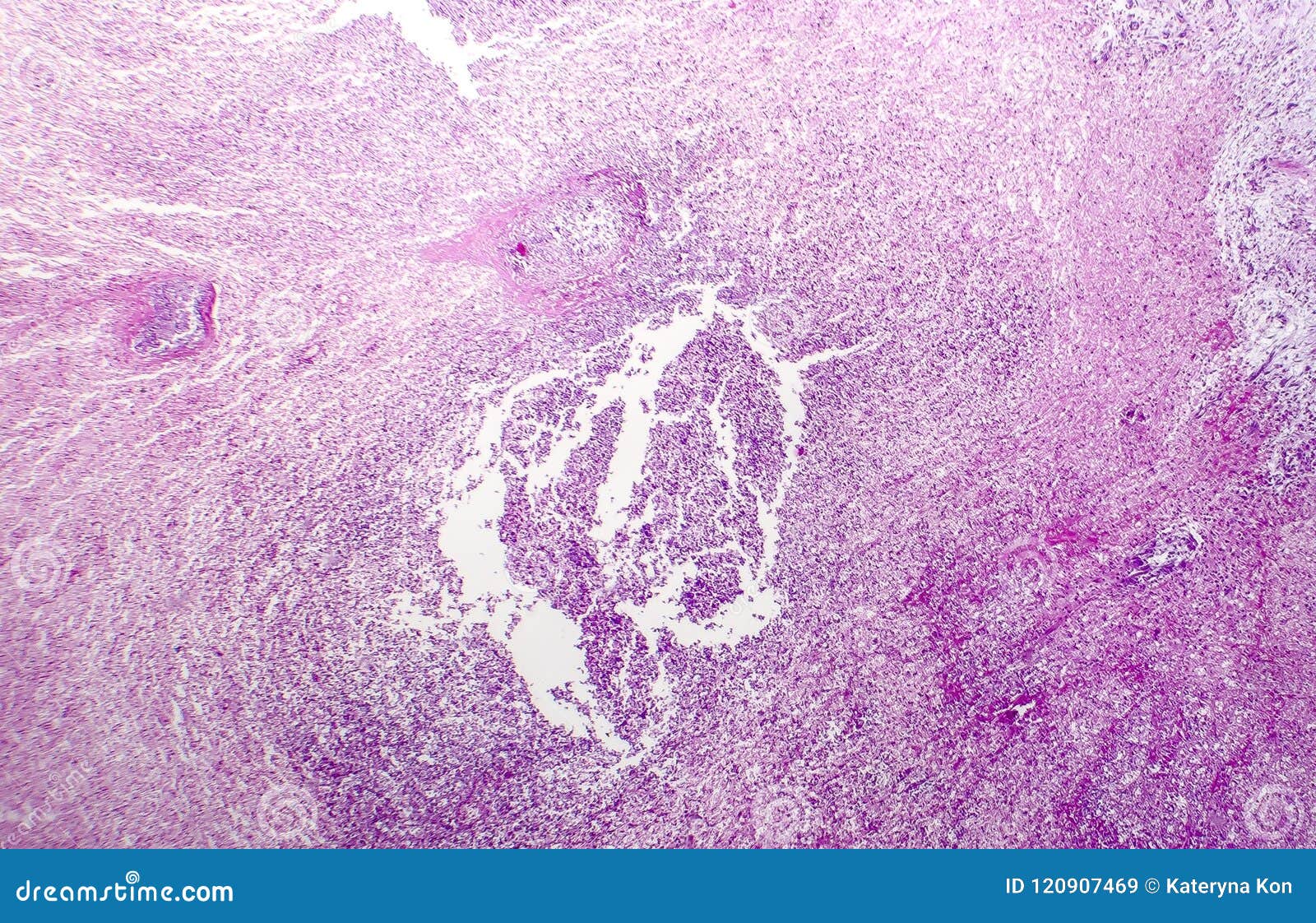 Splenic Infarction, Photo Under Microscope Stock Image - Image of ...