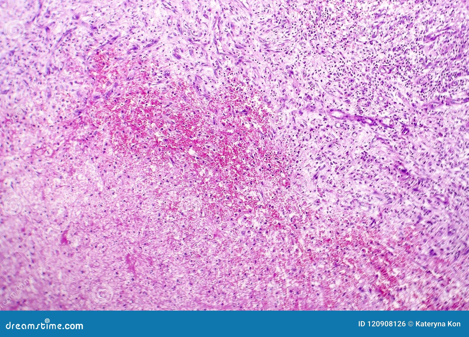 Splenic Infarction, Photo Under Microscope Stock Photo - Image of ...
