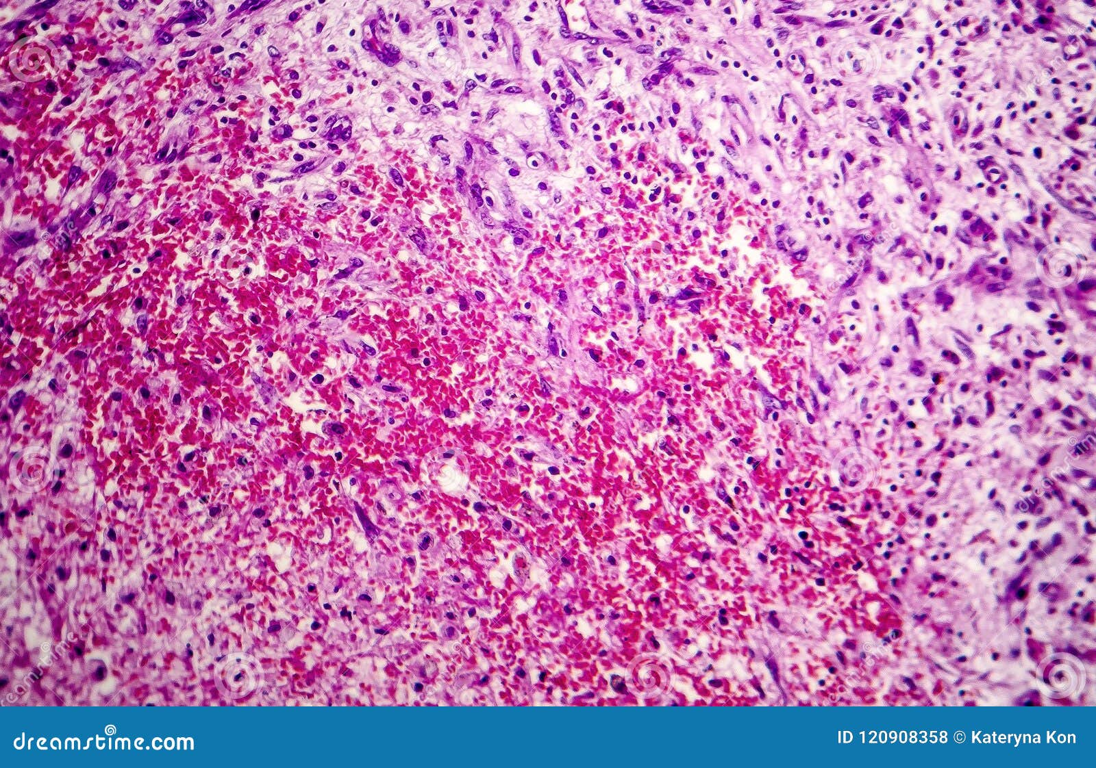 Splenic Infarction, Photo Under Microscope Royalty-Free Stock ...