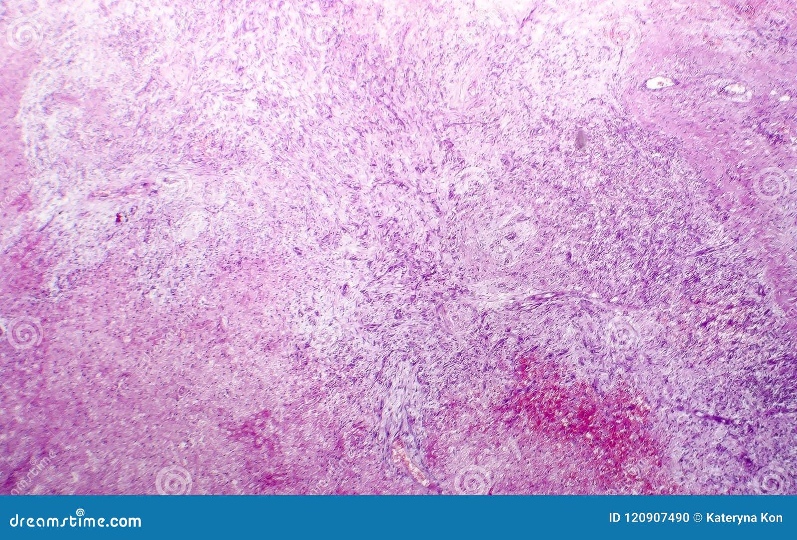 Splenic Infarction, Photo Under Microscope Royalty-Free Stock ...