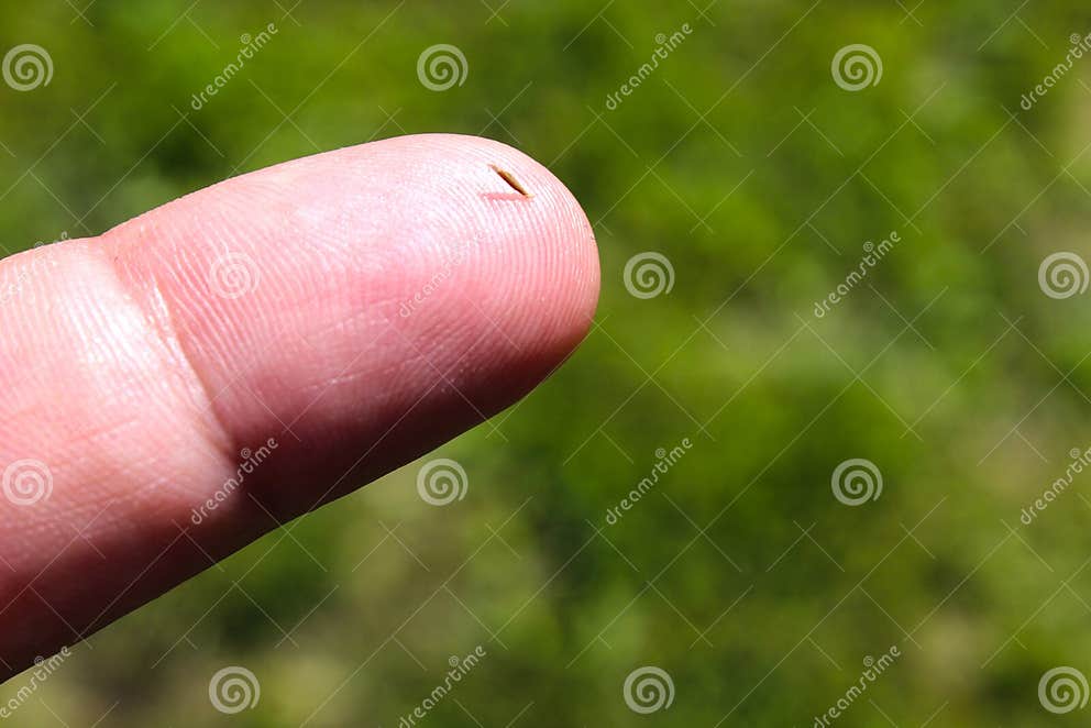A splinter in the finger stock image. Image of bite - 150025677