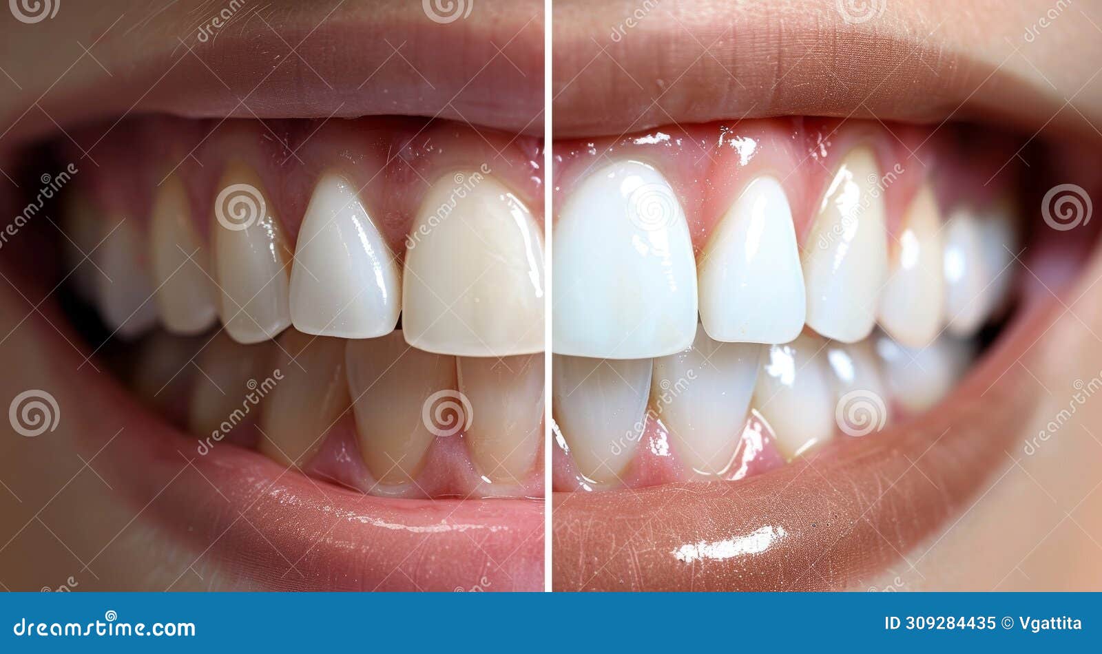 Split Image Comparison Showing the Remarkable Results of Teeth ...