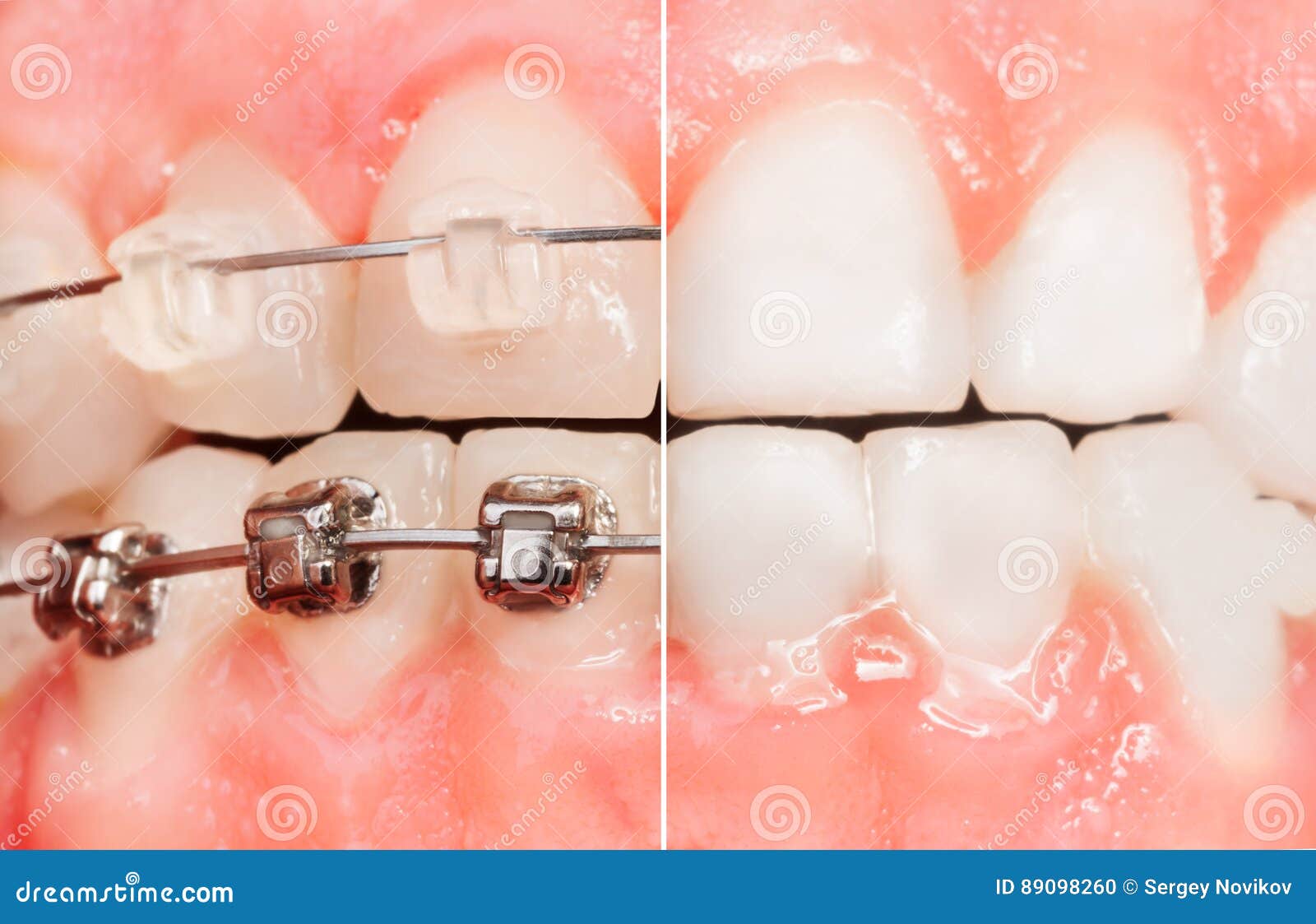 Split View of Braces and Tooth before Them Stock Photo - Image of ...