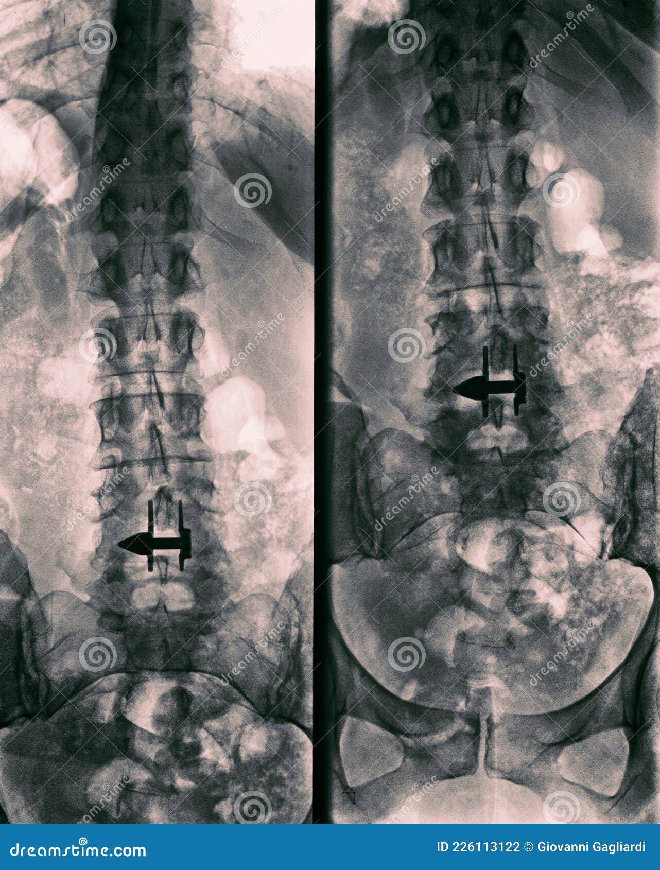 Split View of Human Spine X-ray Stock Photo - Image of vertebra ...