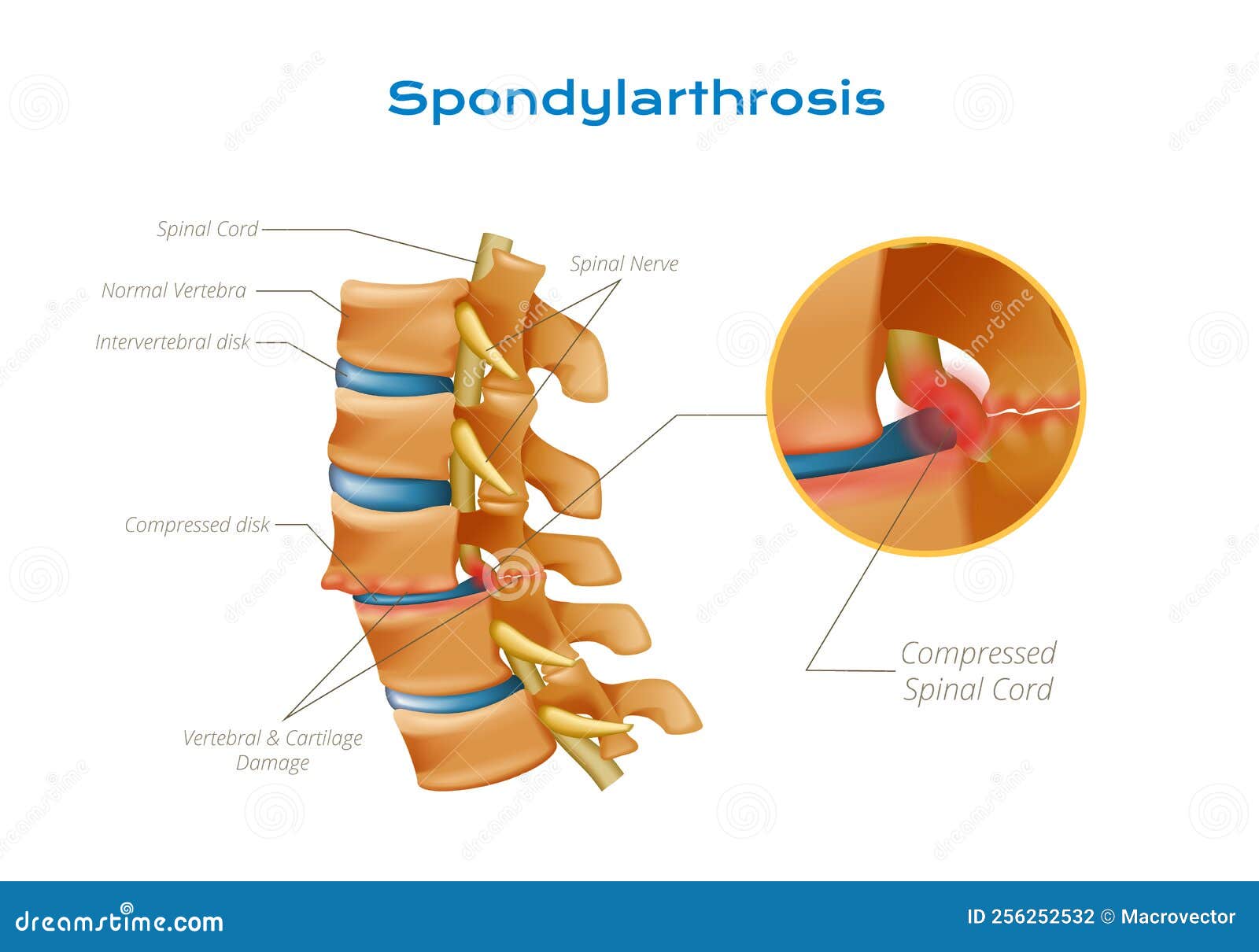 Spondylarthrosis Spinal Cord Infographics Stock Vector - Illustration ... Spondylarthrosis Spinal Cord Infographics Stock Vector - Illustration ...