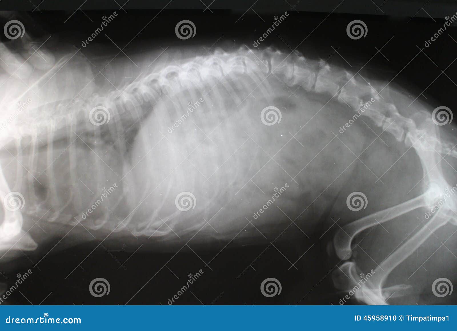Chest Deformity, Birth Defect. Strong Deformity. Pectus Excavatus ...