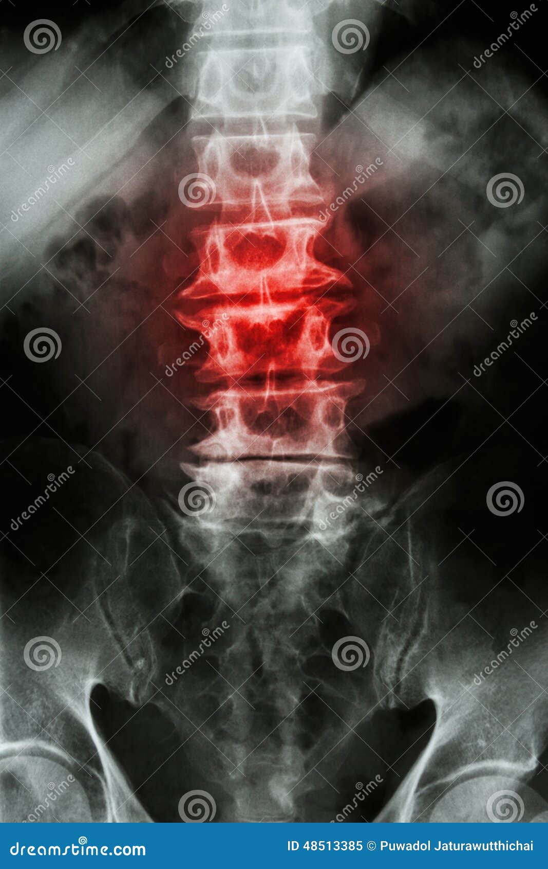 Spondylose illustration stock. Illustration du diagnostic - 48513385