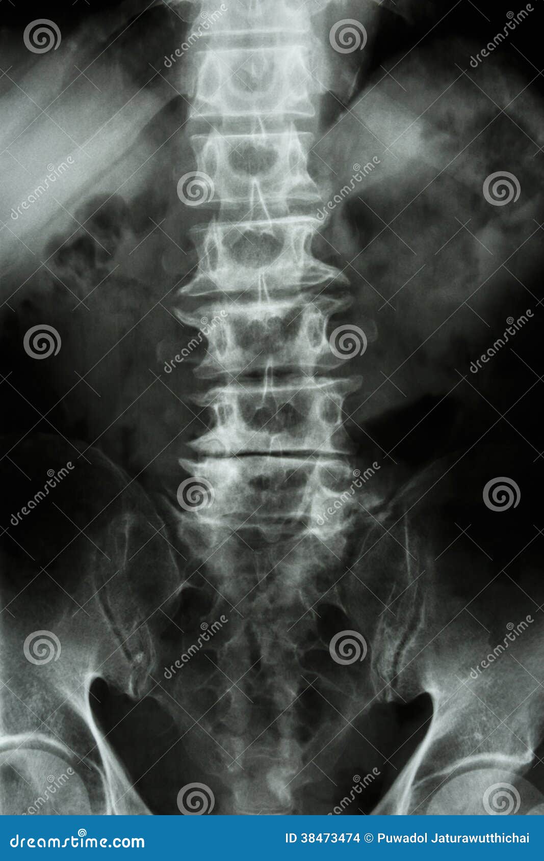 Spondylosis stock foto. Image of menselijk, zorg, ziekte - 38473474