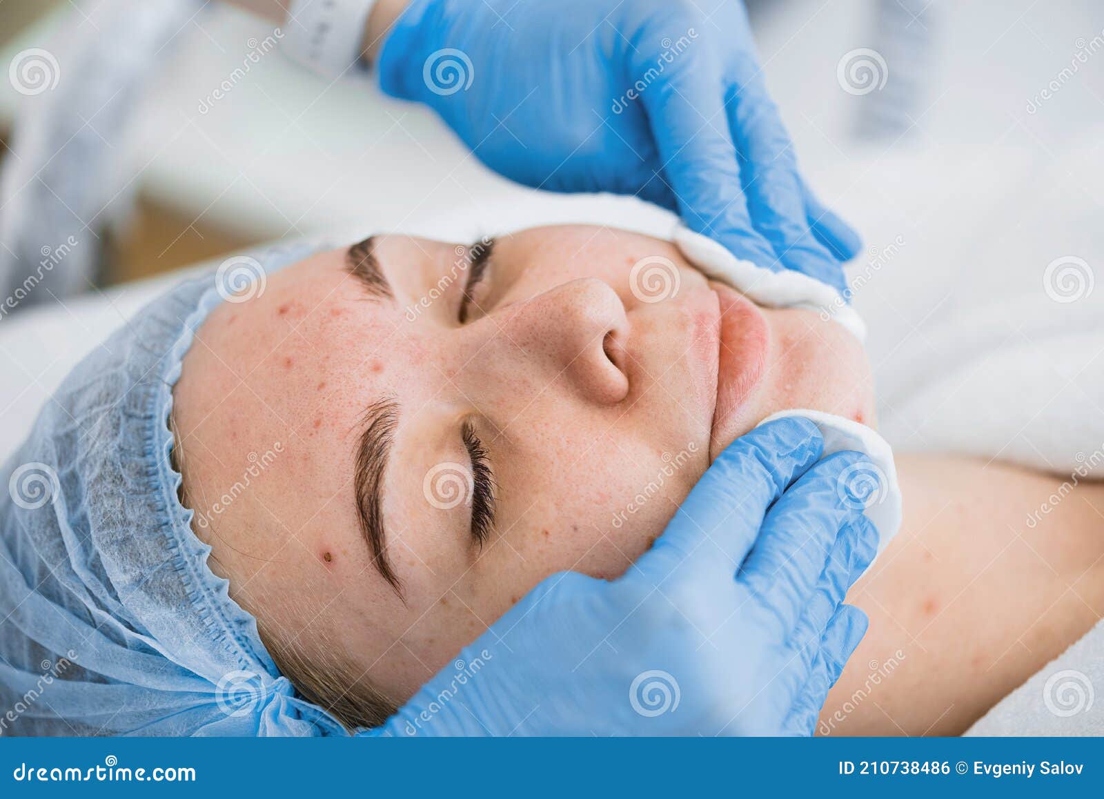 Sponge Application of the Mask on the Face with Problem Skin Stock ...