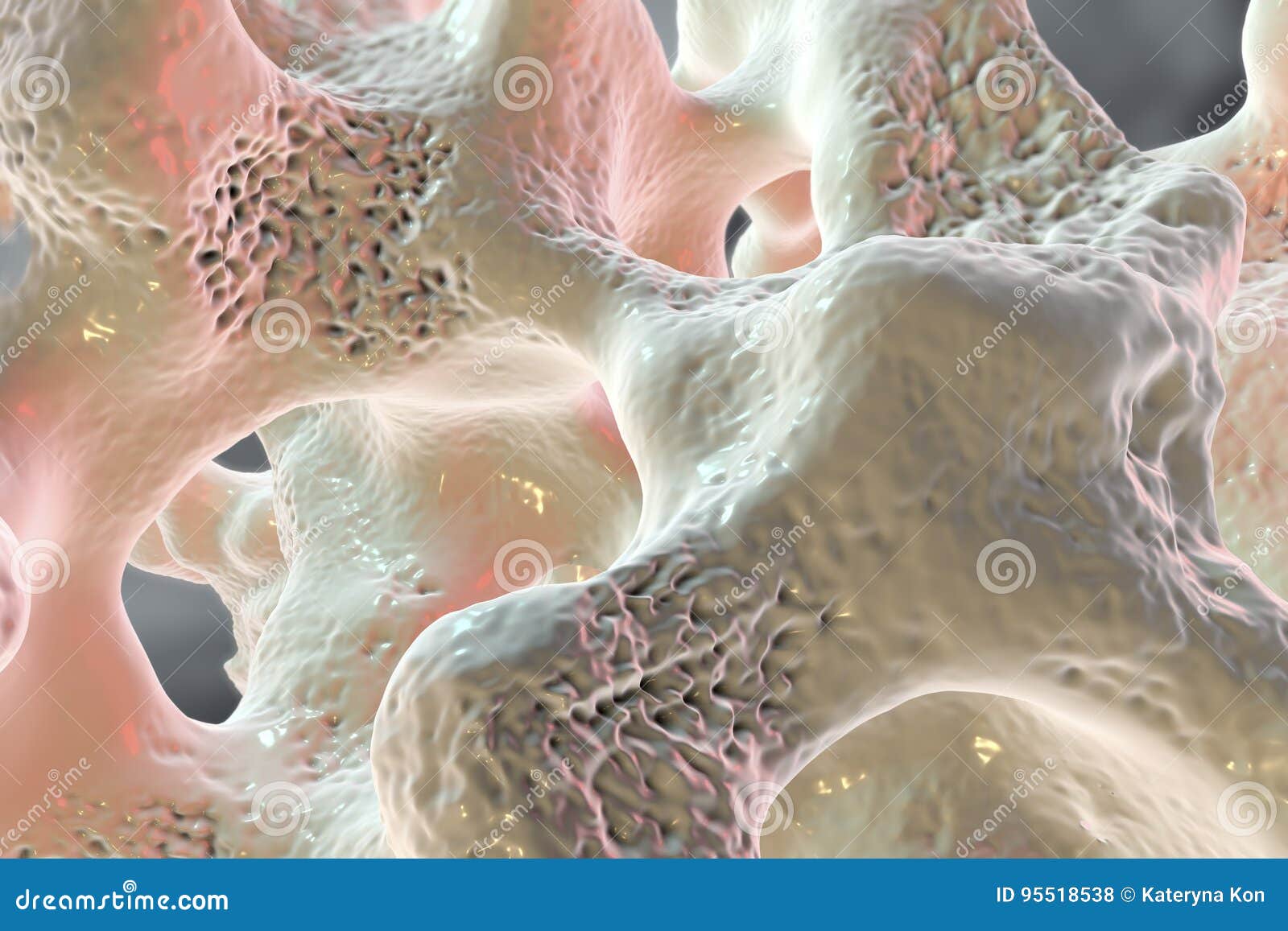Sponzig Beenweefsel Dat Door Osteoporose Wordt Getroffen Stock ...