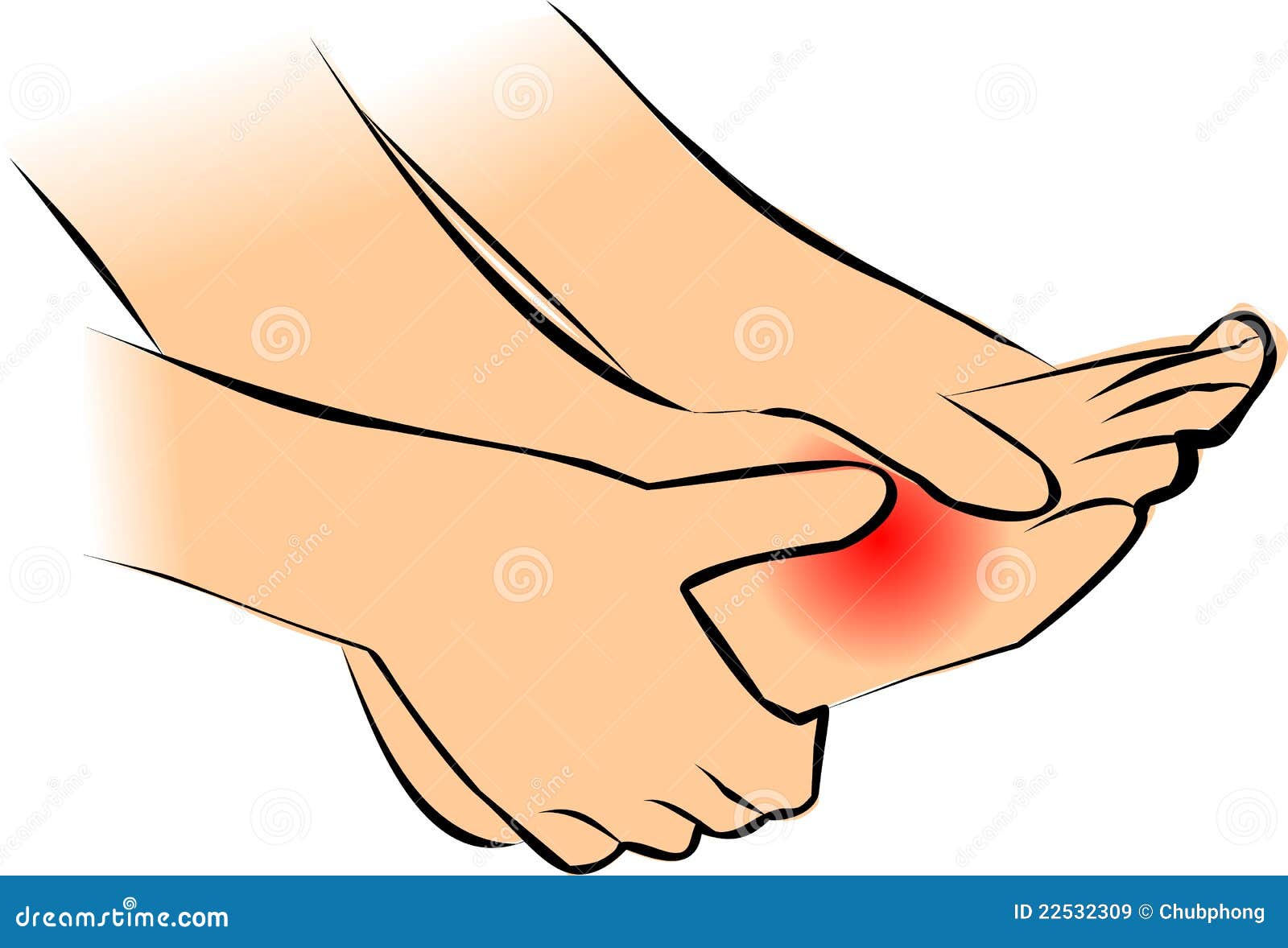 Sprain stock illustration. Illustration of lesion, wound - 22532309