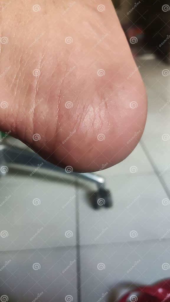 Sprained leg stock photo. Image of kaki, sakit, ambd - 279880294