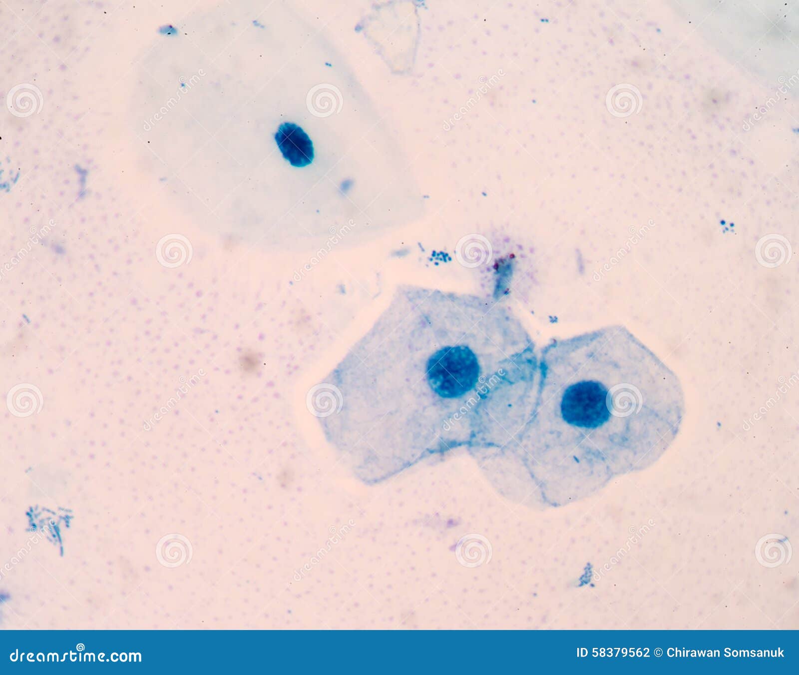 Squamous Cell Carcinoma Of The Eyeball Royalty-Free Stock Photo ...