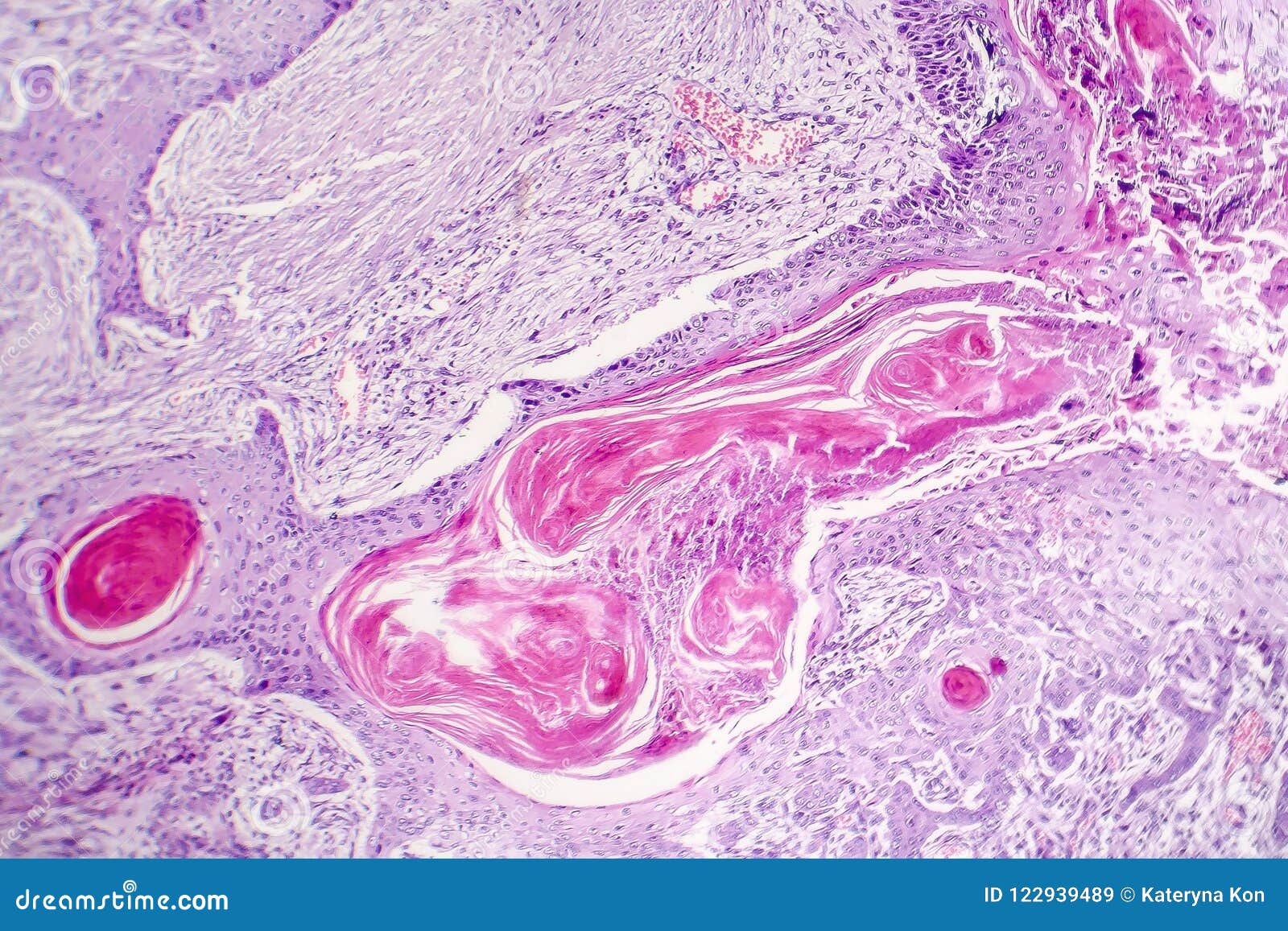 Squamous cell carcinoma stock image. Image of pearls - 122939489