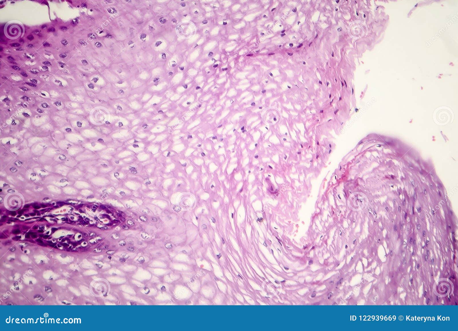 Squamous cell carcinoma stock image. Image of magnification - 122939669