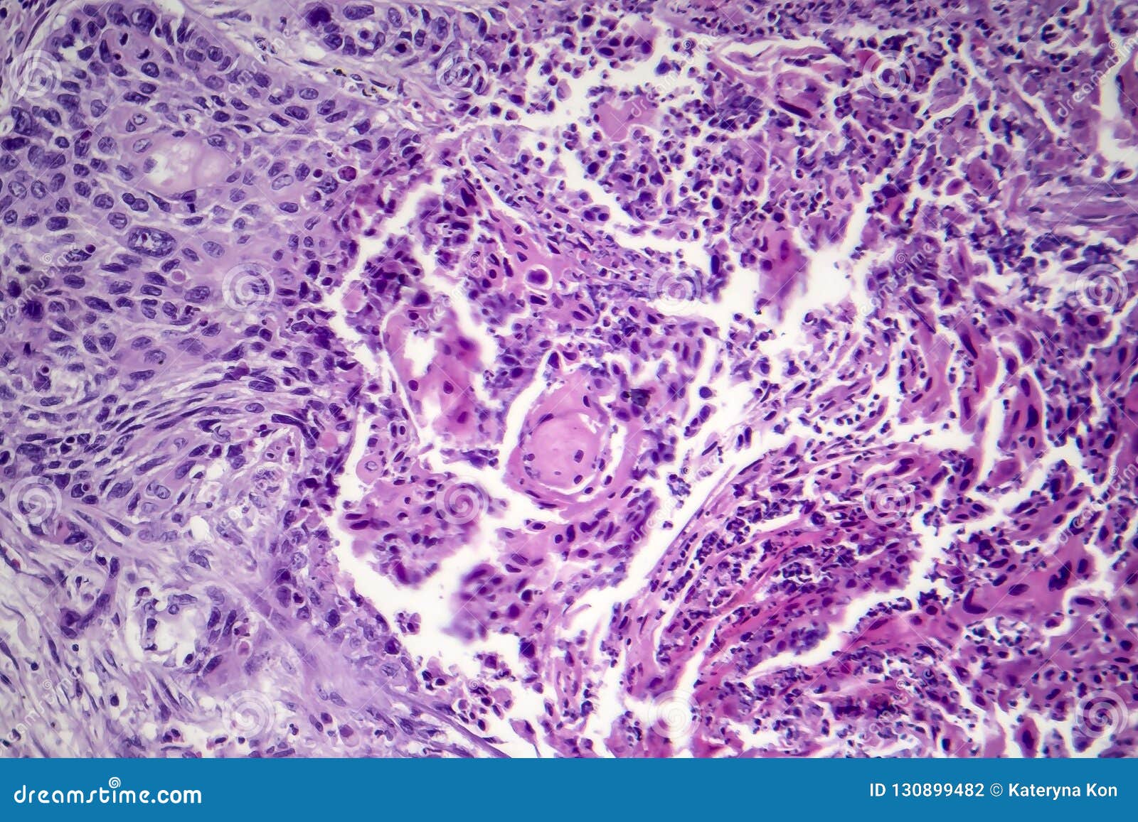 Squamous Cell Carcinoma Of The Lung Stock Photography | CartoonDealer ... Squamous Cell Carcinoma Of The Lung Stock Photography | CartoonDealer ...