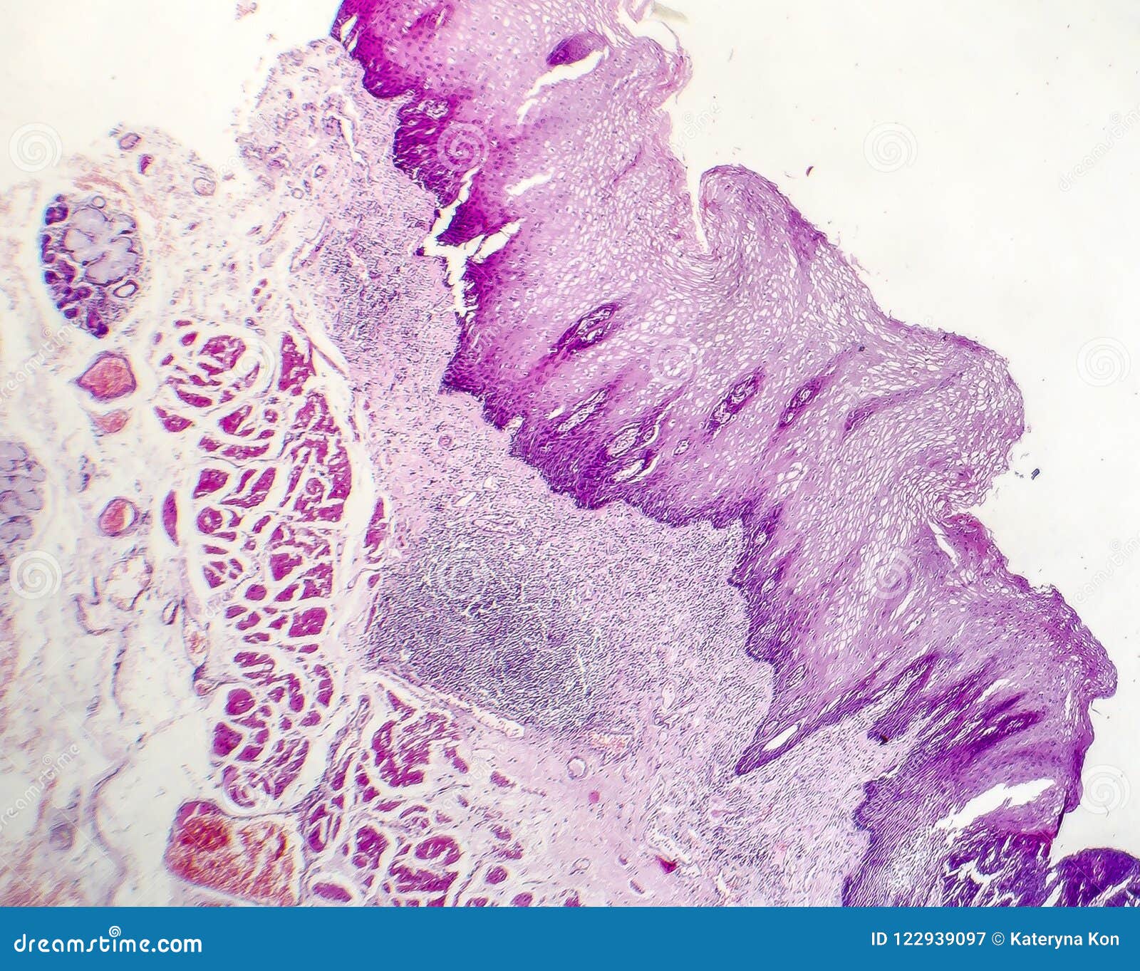 Squamous cell carcinoma stock image. Image of micro - 122939097
