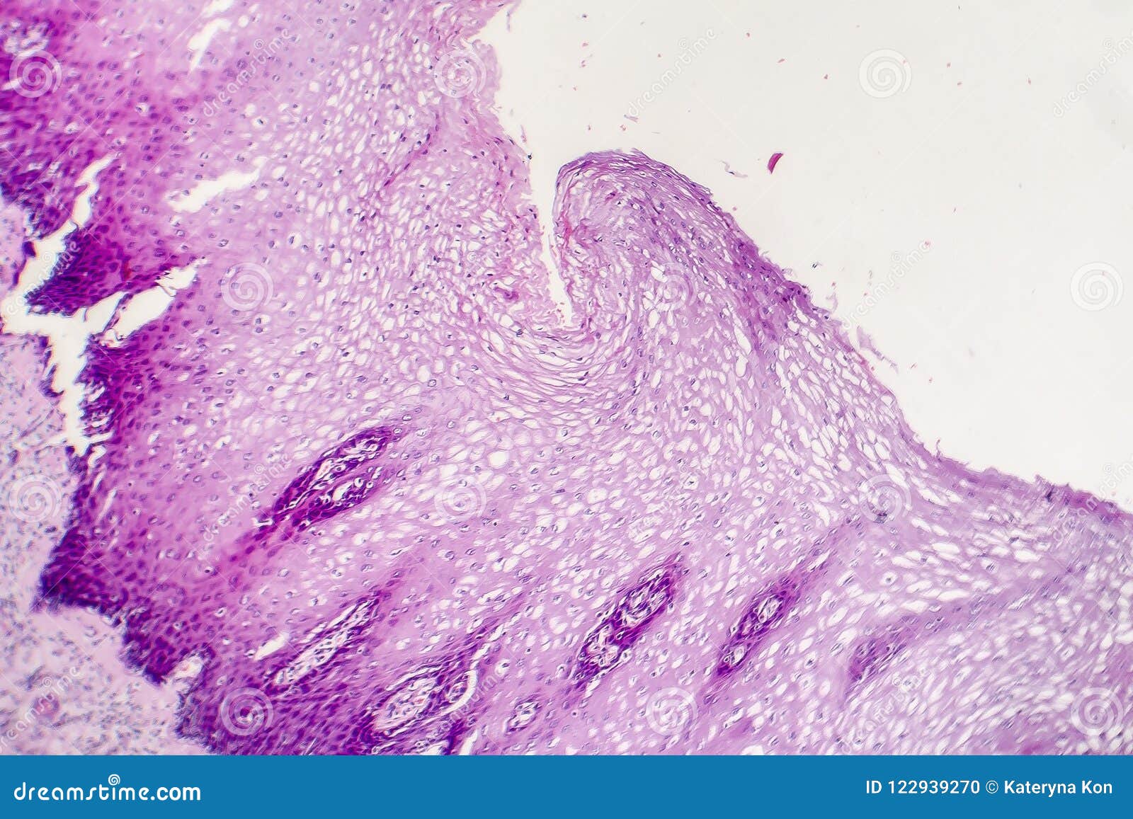 Squamous cell carcinoma stock photo. Image of cell, cancerous - 122939270