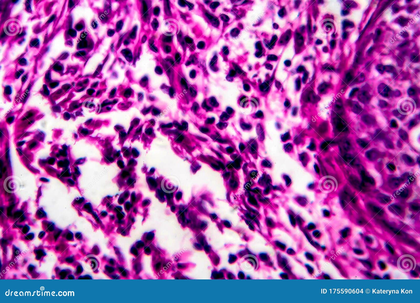 Squamous Cell Carcinoma Of The Eyeball Royalty-Free Stock Photo ...