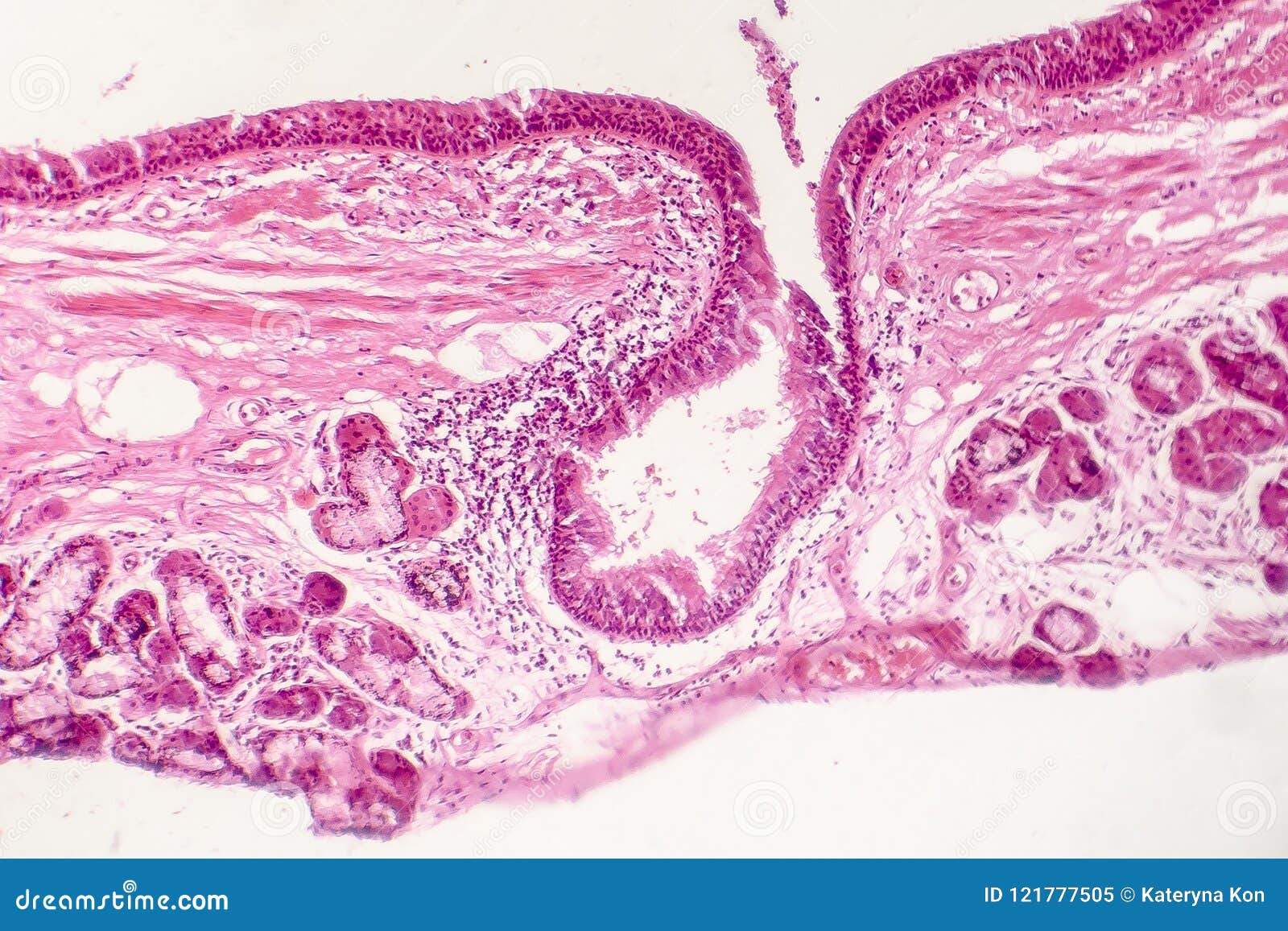 Squamous Metaplasia Av Bronkial Epitel Fotografering för Bildbyråer ...