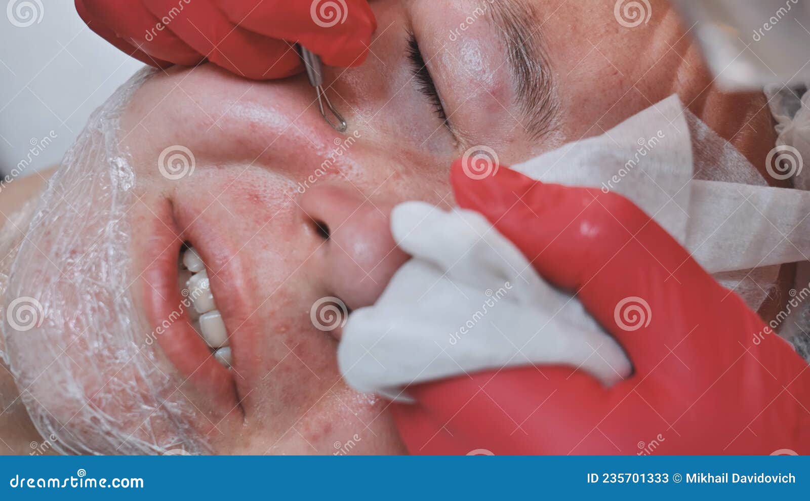 Squeezing Acne from a Girl with Problem Skin in the Salon Using a Loop ...