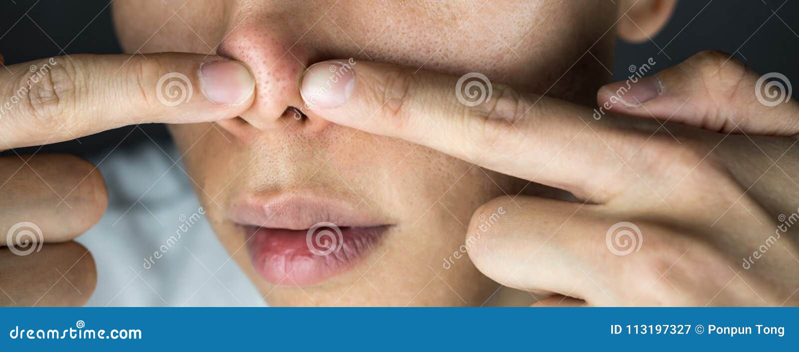 Acne On The Nose And Black Spots Caused By Melasma. Royalty-Free Stock ...