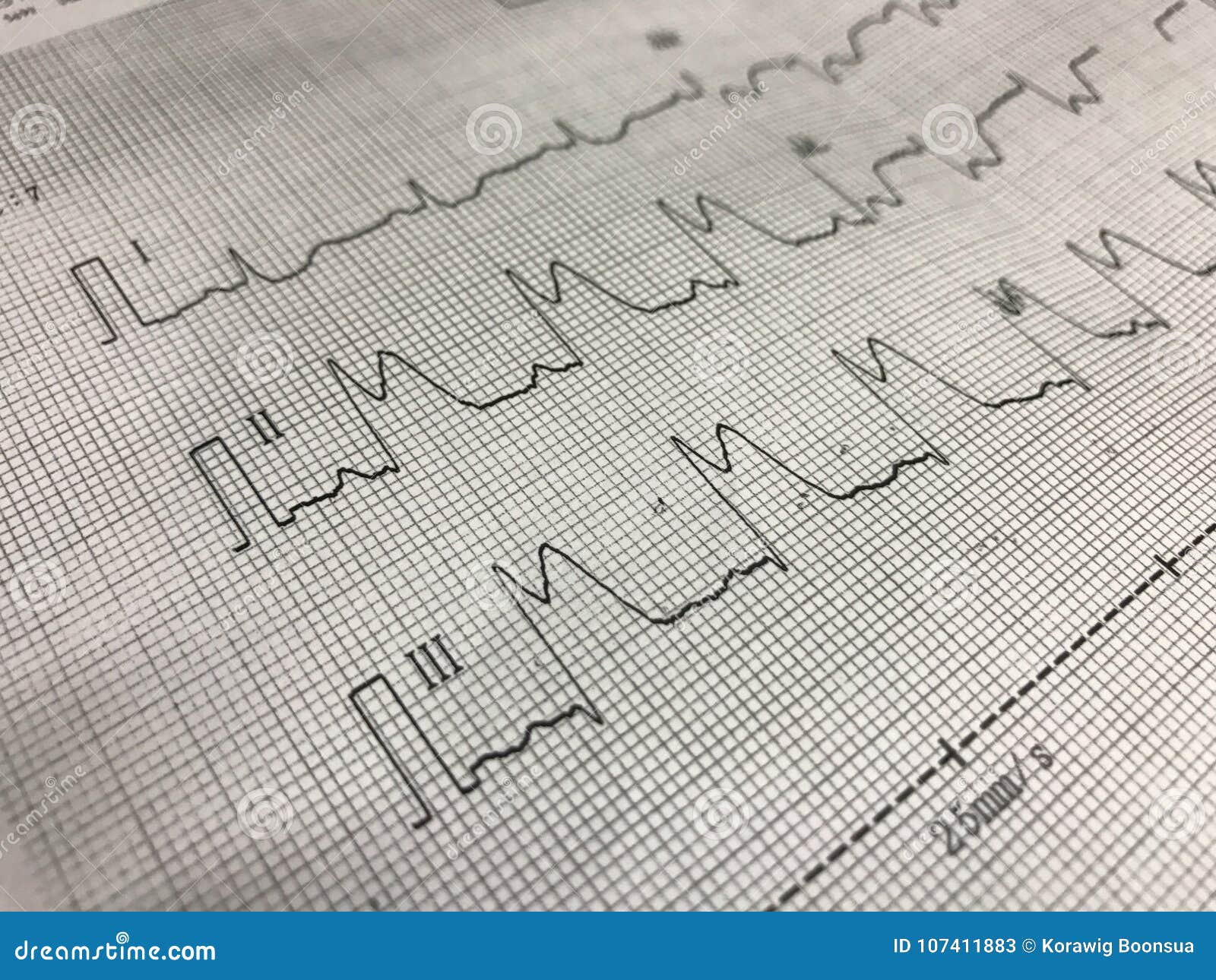 ST Elevation On ECG Paper Stock Image | CartoonDealer.com #107412139