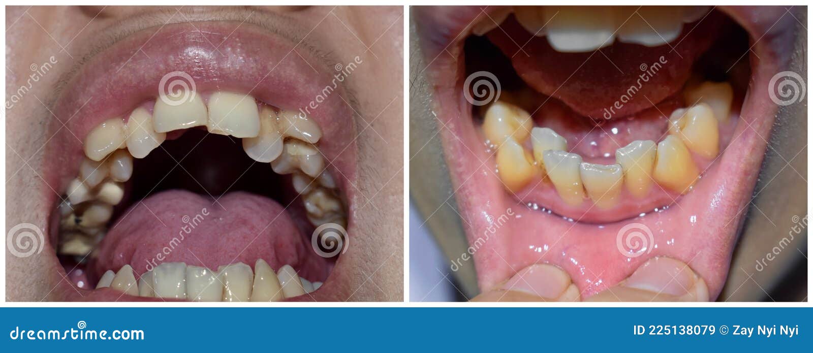 Stacked or Overlapping Teeth of Asian Man. Also Called Crowded Teeth ...