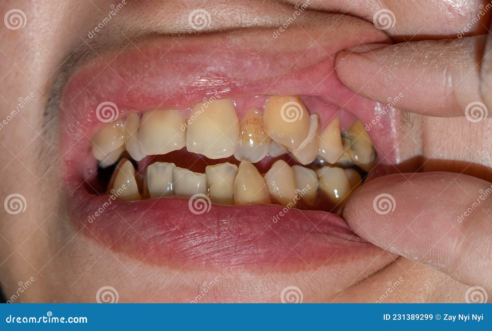 Stacked or Overlapping Teeth with Yellow Stain. Also Called Crowded ...