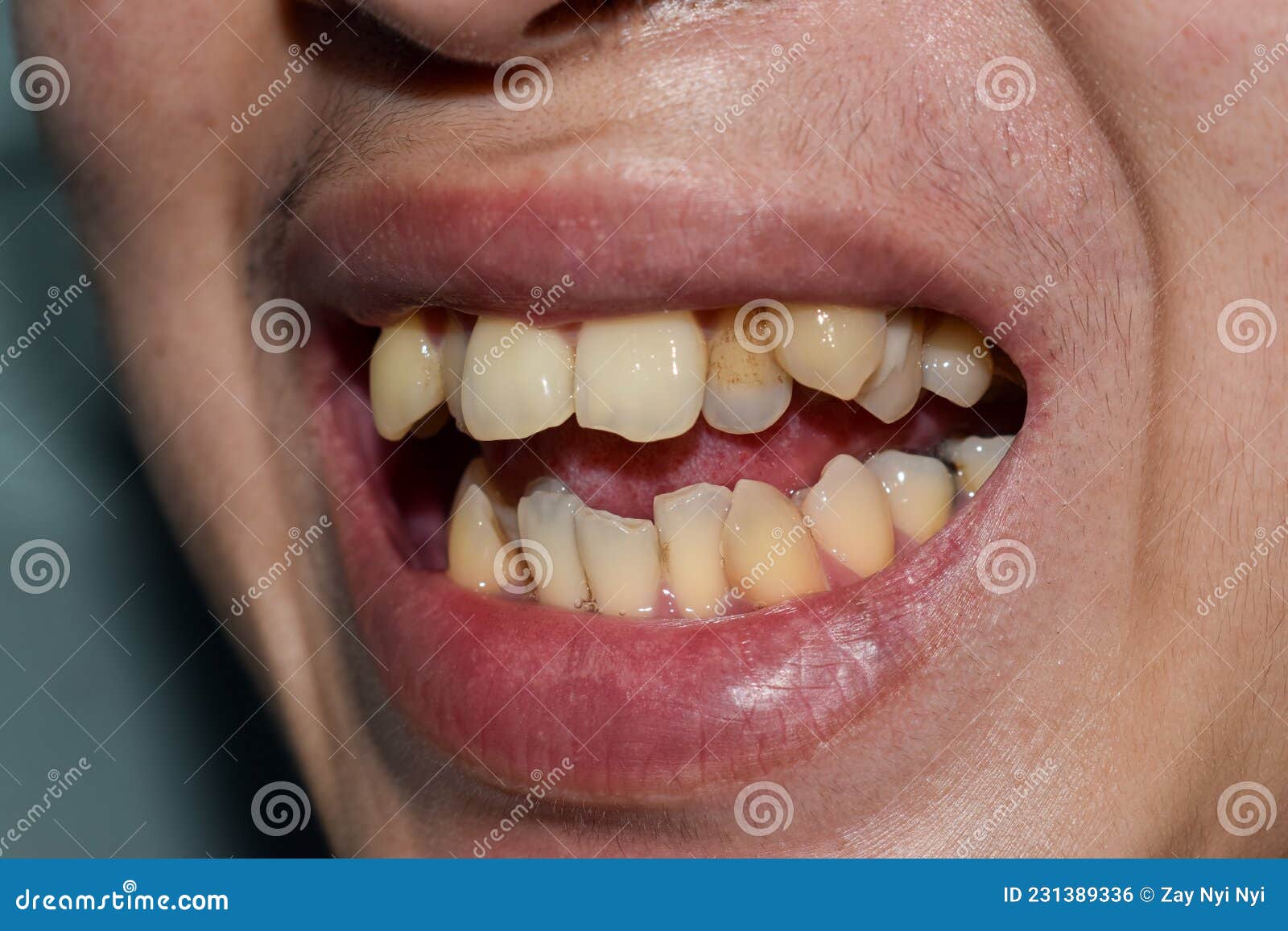 Stacked or Overlapping Teeth with Yellow Stain. Also Called Crowded ...