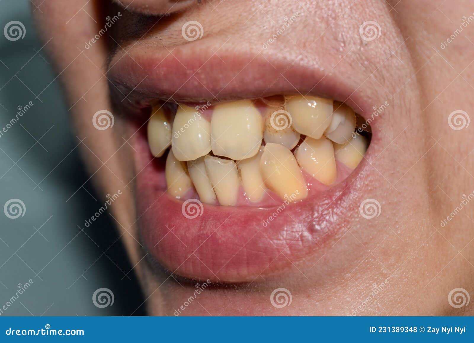 Stacked or Overlapping Teeth with Yellow Stain. Also Called Crowded ...