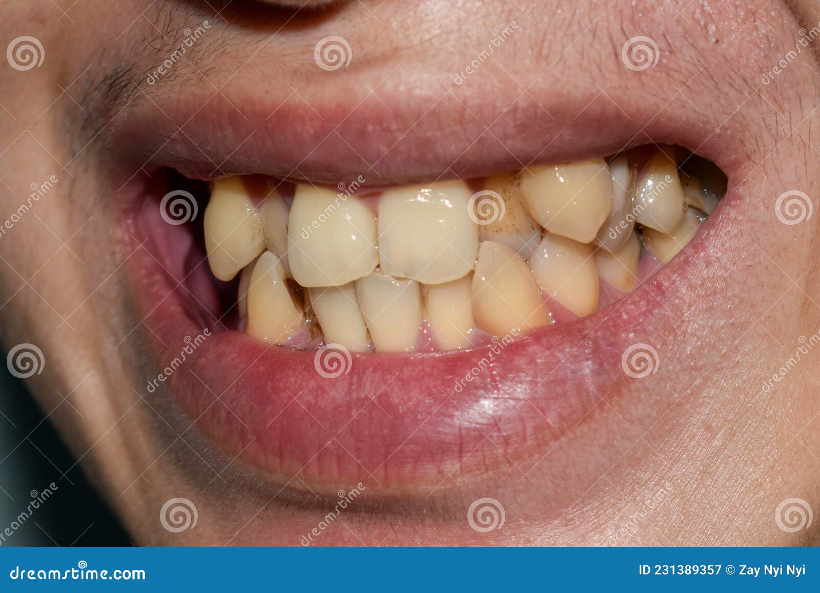 Stacked or Overlapping Teeth with Yellow Stain. Also Called Crowded ...
