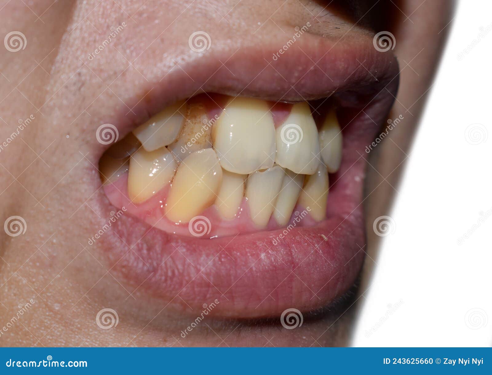 Stacked or Overlapping Teeth with Yellow Stain. Also Called Crowded ...