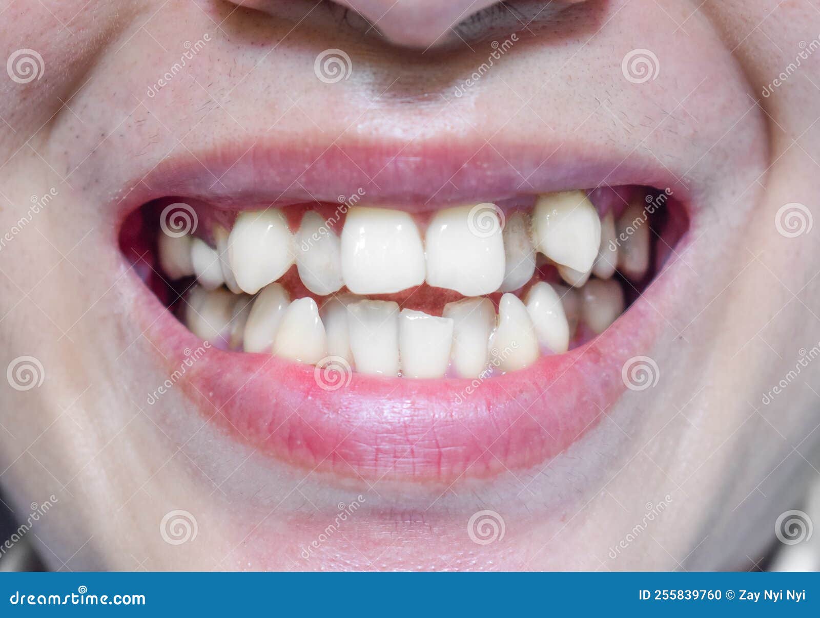 Stacked or Overlapping White Teeth. Also Called Crowded Teeth Stock ...