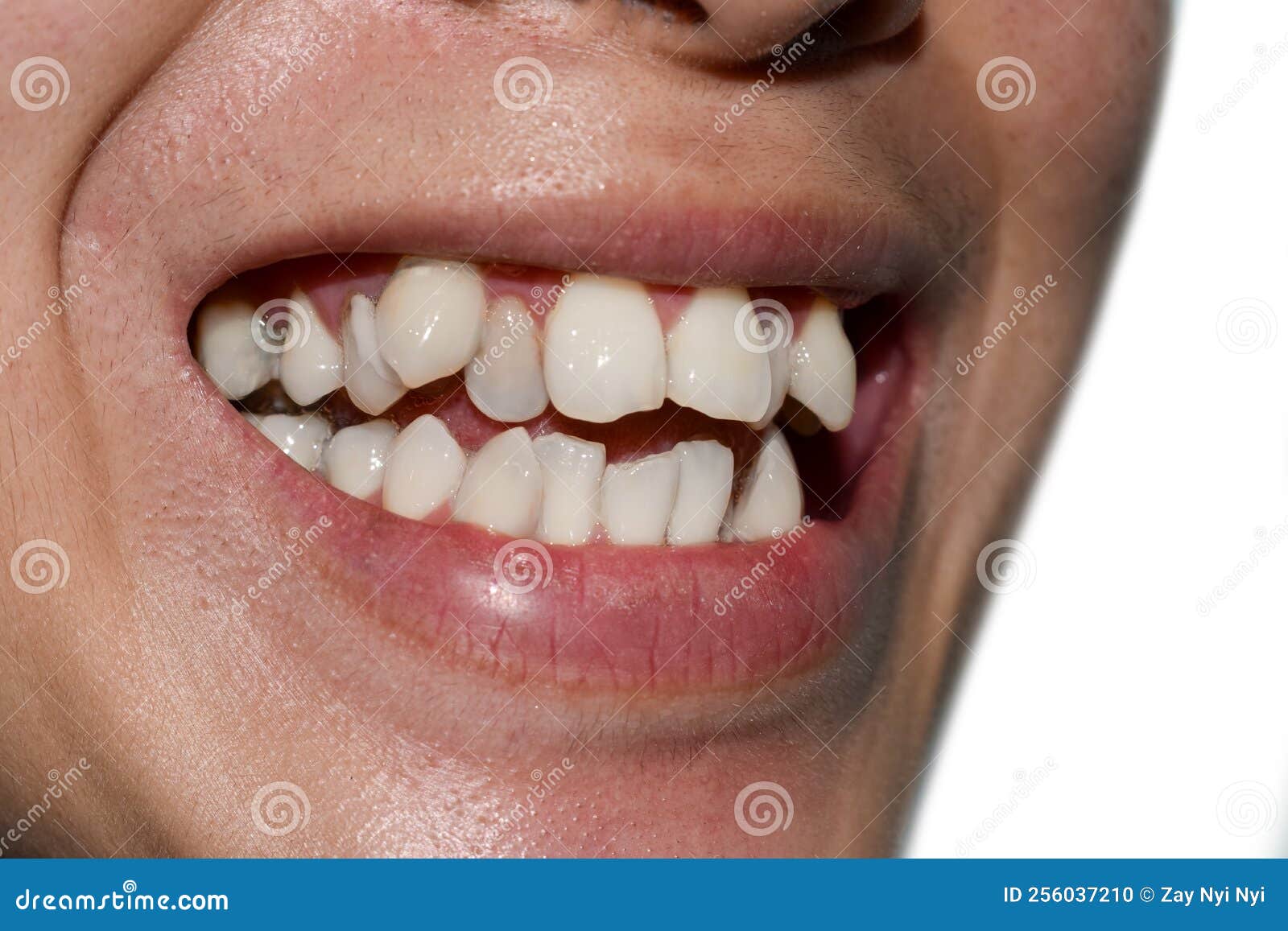 Stacked or Overlapping White Teeth. Also Called Crowded Teeth Stock ...