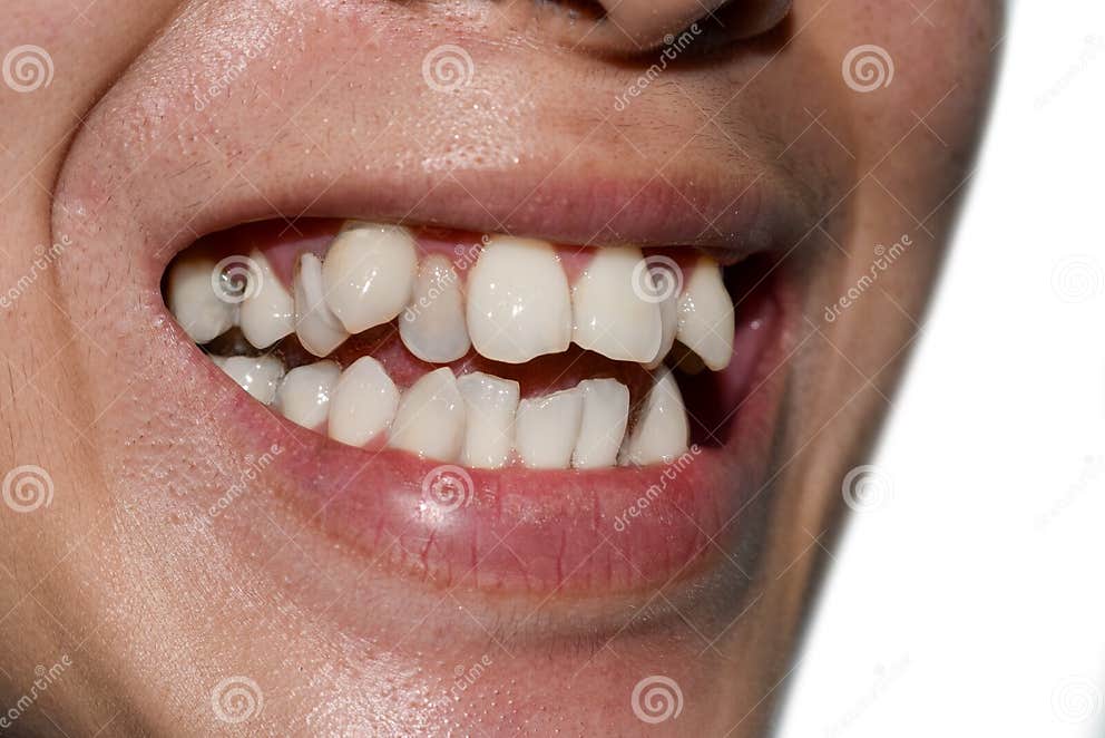 Stacked or Overlapping White Teeth. Also Called Crowded Teeth Stock ...