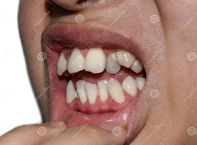 Stacked or Overlapping White Teeth. Also Called Crowded Teeth Stock ...
